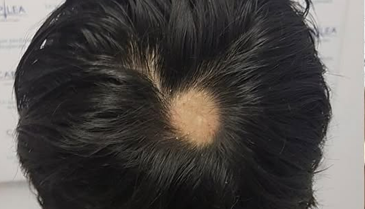 ¿Cuáles Son los Tipos de Alopecia que Existen? - Capilea
